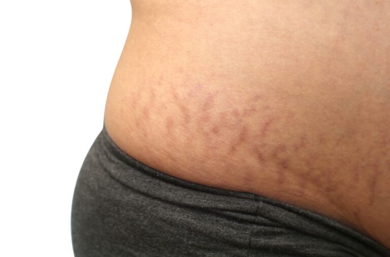 Estrías, todo lo que tienes que saber, ¿Qué son? Tipos, zonas ...