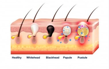 Todo sobre las espinillas: la guía donde resolverás todas tus dudas ...