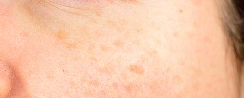 ¿Cómo quitar manchas del sol en la cara? | Blog Druni