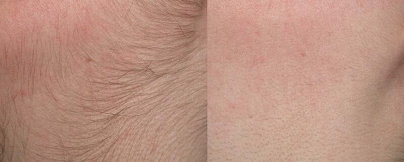 Vello facial en mujeres: Mejores consejos para eliminarlos o ...