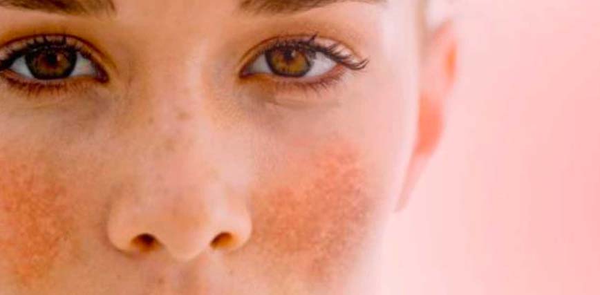 ¿cómo Quitar Manchas Del Sol En La Cara Blog Druni