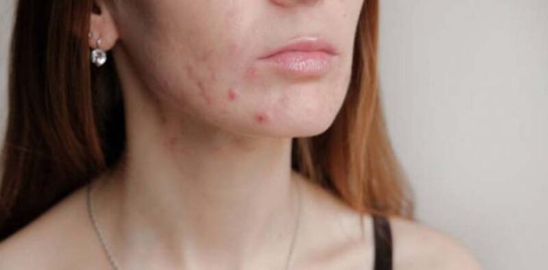 Granos enquistados: Causas, tratamiento y prevención | Blog Druni