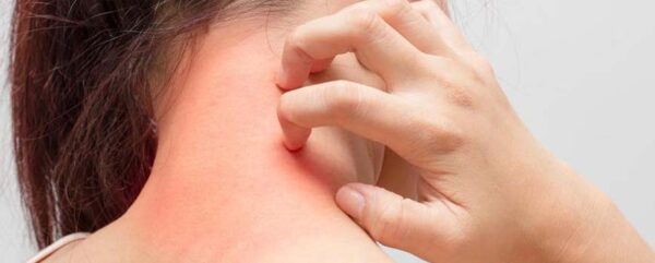 Alergia al sol: qué es, por qué aparece, síntomas y tratamiento | Blog ...