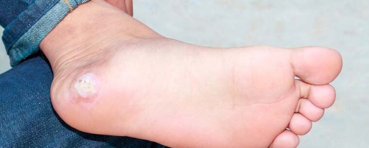 Cómo quitar callos de los pies de forma rápida y sencilla | Blog Druni