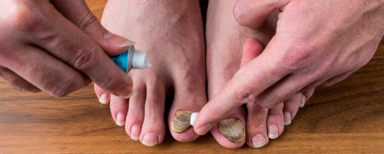 Di adiós a los hongos en las uñas: descubre el mejor tratamiento para ...