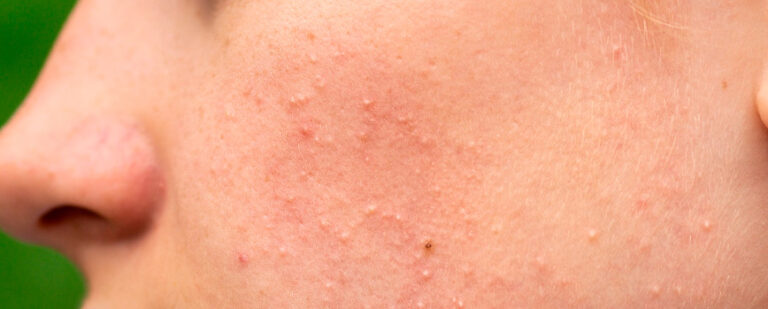 Comedones: Qué son y cómo tratar los puntos negros | Blog Druni