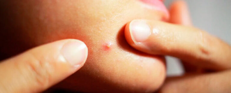 Granos enquistados: Causas, tratamiento y prevención | Blog Druni