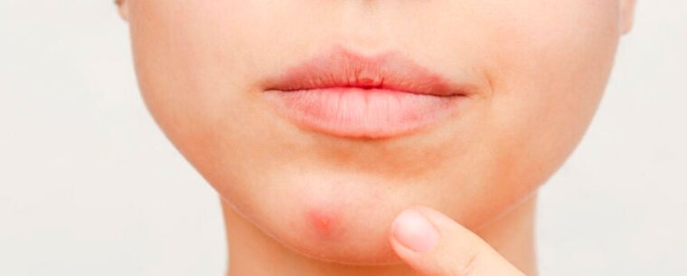 Granos enquistados: Causas, tratamiento y prevención | Blog Druni