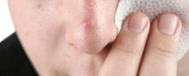 Granos externos en la nariz: Causas comunes y consejos para eliminarlos ...