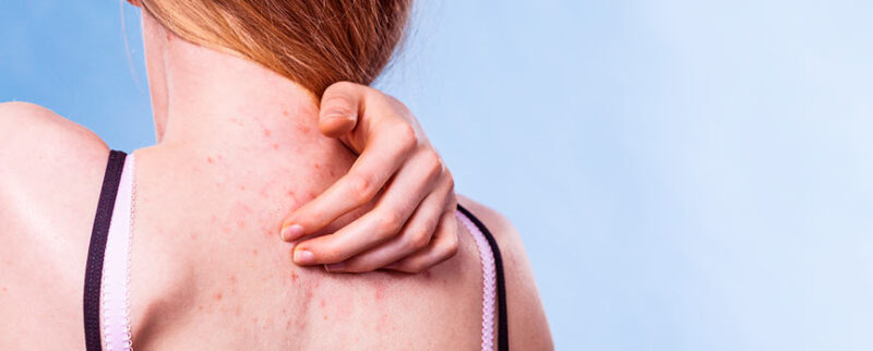 ¡Adiós al bacné! Cómo combatir el acné en la espalda de forma efectiva ...