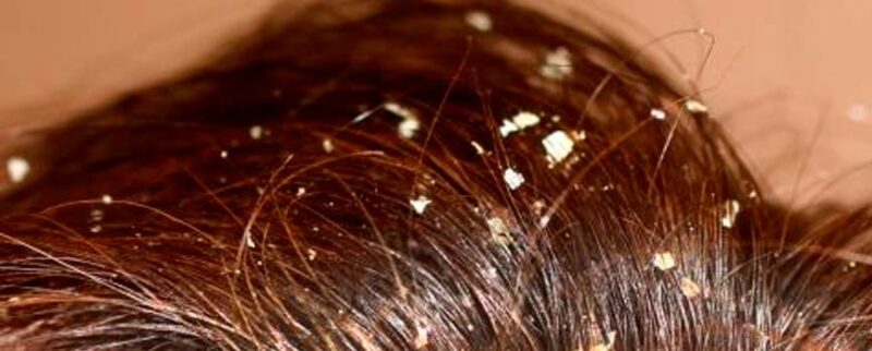 Causas y soluciones: Cómo lidiar con la descamación del cuero cabelludo ...