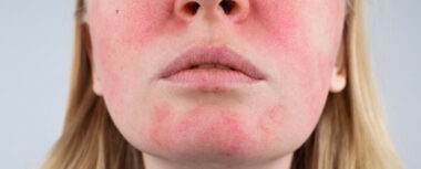 ¿Qué es la cuperosis y cómo tratarla? | Blog Druni