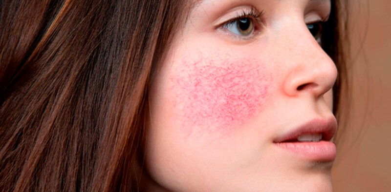 ¿Qué es la cuperosis y cómo tratarla? | Blog Druni