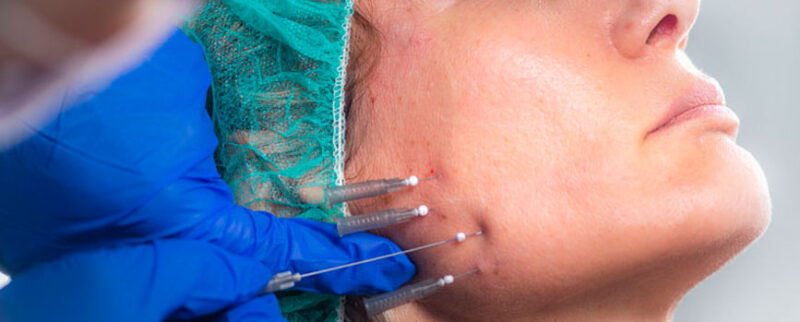 Cómo conseguir un lifting facial sin necesidad de cirugía | Blog Druni