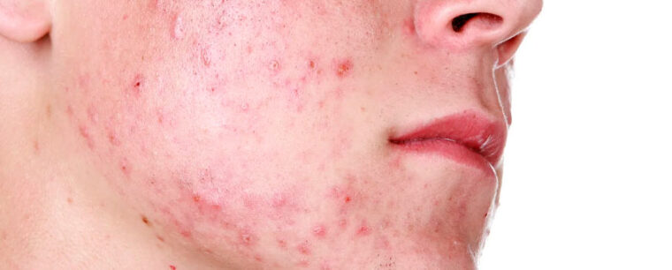 Acné conglobata: ¿qué es y cómo tratarlo? | Blog Druni