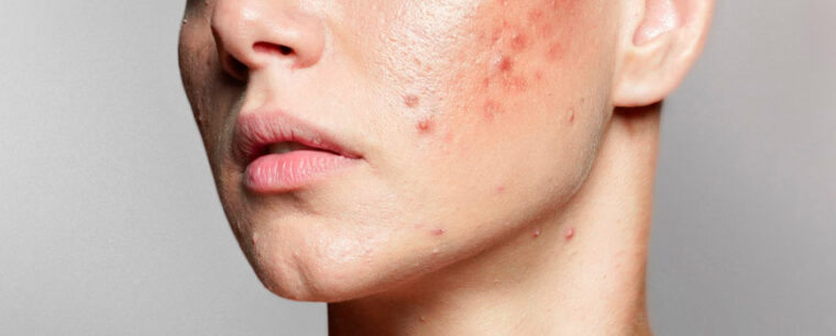 Acné conglobata: ¿qué es y cómo tratarlo? | Blog Druni