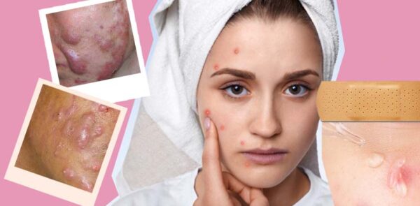 Las mejores cremas para el acné que son efectivas | Blog Druni