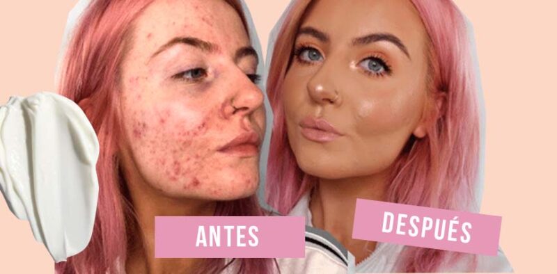 Las mejores cremas para el acné que son efectivas | Blog Druni