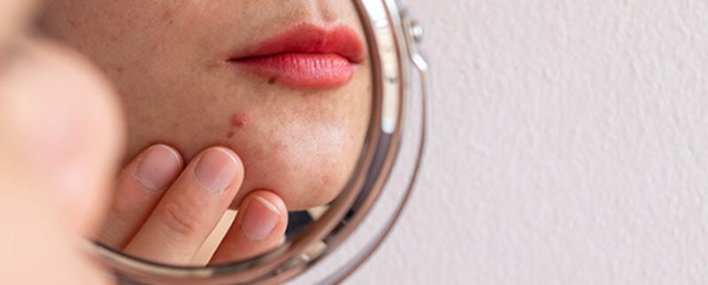 Acné vulgar: ¿Qué es y tratamiento? | Blog Druni