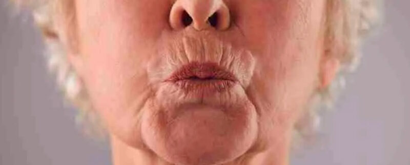 ¿Qué son las arrugas nasogenianas y cómo tratarlas? | Blog Druni