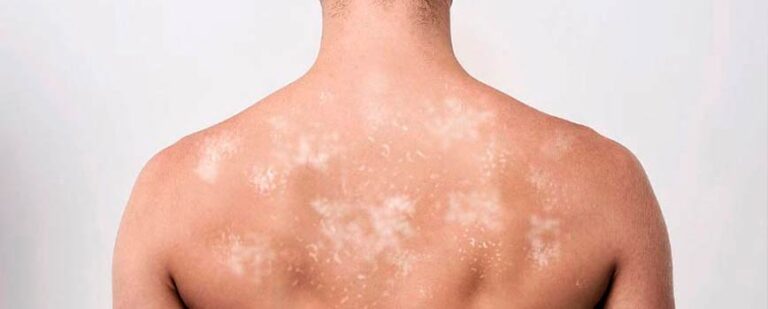 Hongos en la piel: ¿Cómo identificarlos y cómo tratarlos? | Blog Druni