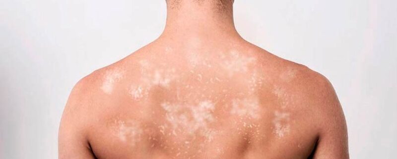 Hongos en la piel: ¿Cómo identificarlos y cómo tratarlos? | Blog Druni