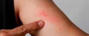 Hongos en la piel: ¿Cómo identificarlos y cómo tratarlos? | Blog Druni