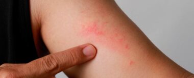 Hongos en la piel: ¿Cómo identificarlos y cómo tratarlos? | Blog Druni