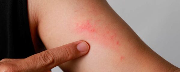 Hongos en la piel: ¿Cómo identificarlos y cómo tratarlos? | Blog Druni