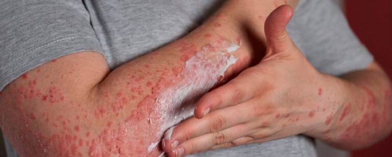 Hongos en la piel: ¿Cómo identificarlos y cómo tratarlos? | Blog Druni