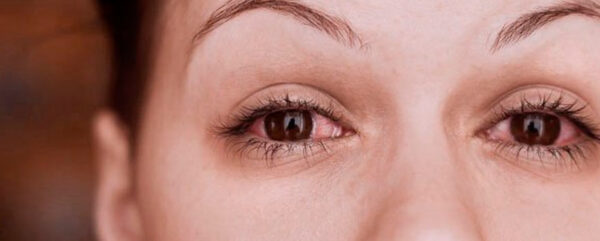 Infección ocular: ¿Qué es y cómo evitarla? | Blog Druni