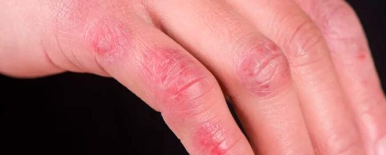 Cómo curar los sabañones en las manos | Blog Druni