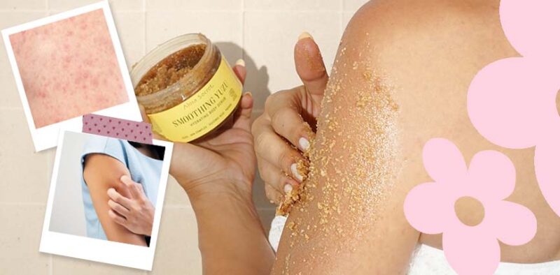 ¿Cómo bajar la inflamación de un grano? | Blog Druni