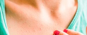 Granos en el pecho: qué hacer y cómo tratarlos | Blog Druni