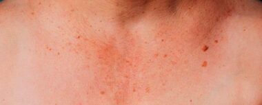 Granos en el pecho: qué hacer y cómo tratarlos | Blog Druni