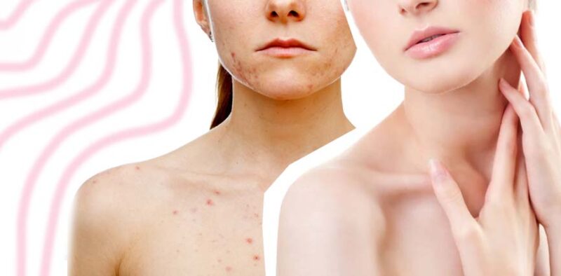 ¿Cómo curar un grano infectado? | Blog Druni