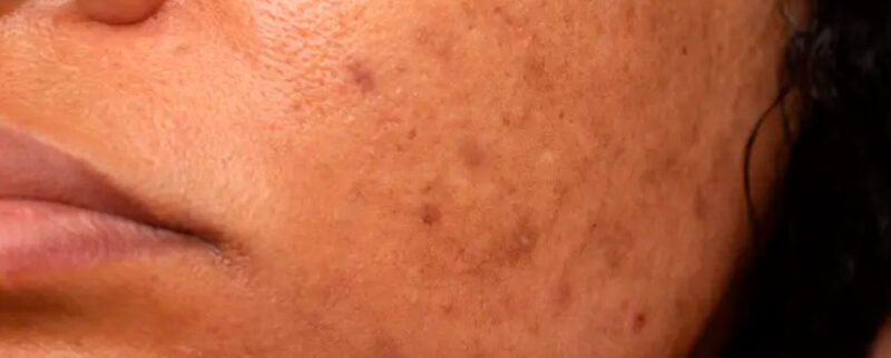 Manchas negras en la piel: ¿por qué aparecen y cómo tratarlas? | Blog Druni