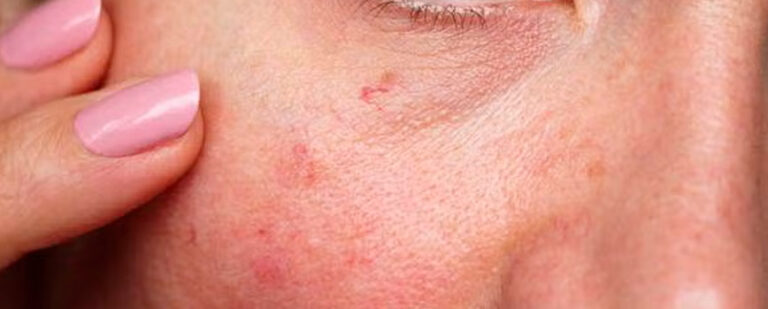 Manchas rosadas en la piel: ¿por qué aparecen y cómo tratarlas? | Blog ...