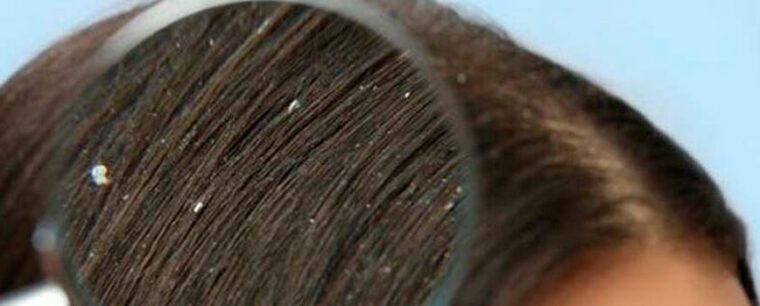 Diferencias entre caspa seca y caspa grasa | Blog Druni