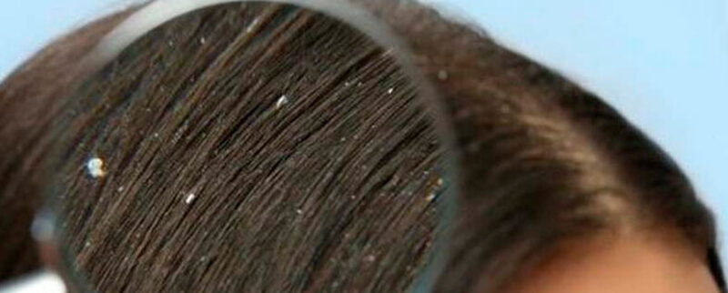 Diferencias entre caspa seca y caspa grasa | Blog Druni