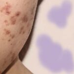 Manchas blancas en la piel: ¿por qué aparecen y cómo tratarlas? | Blog ...