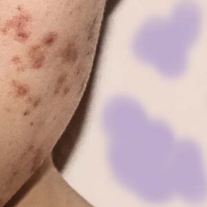 Manchas blancas en la piel: ¿por qué aparecen y cómo tratarlas? | Blog ...
