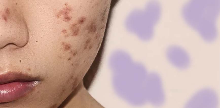 Manchas negras en la piel: ¿por qué aparecen y cómo tratarlas? | Blog Druni