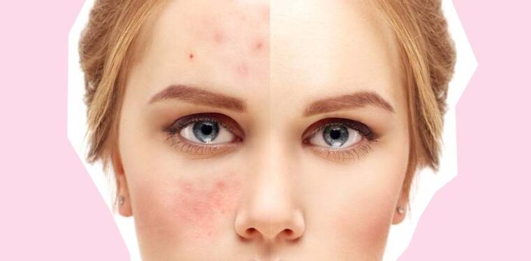 Codos ásperos y secos: Las mejores cremas para codos secos | Blog Druni