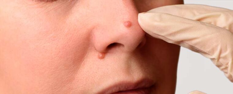 Tipos de verrugas en la cara y cómo quitarlas | Blog Druni