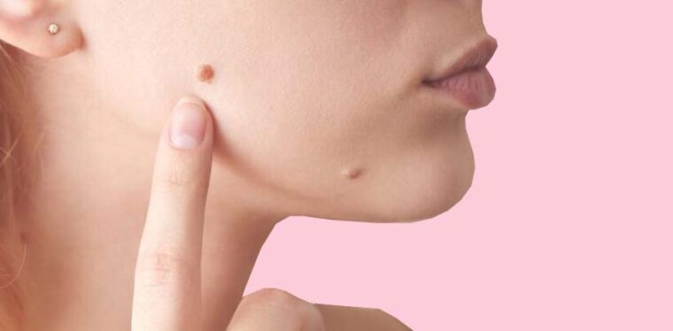 ¿Por qué salen las verrugas en la cabeza y cómo quitarlas? | Blog Druni