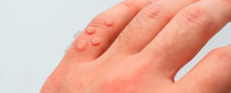 Tipos de verrugas en las manos y cómo quitarlas | Blog Druni