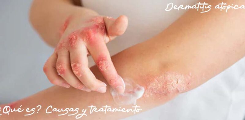 Dermatitis atópica en bebés: causas y tratamiento | Blog Druni