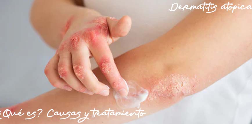 ¿Qué es la dermatitis atópica? Causas y tratamiento | Blog Druni