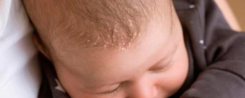 ¿Cómo es la dermatitis seborreica en bebés y cómo se trata? | Blog Druni